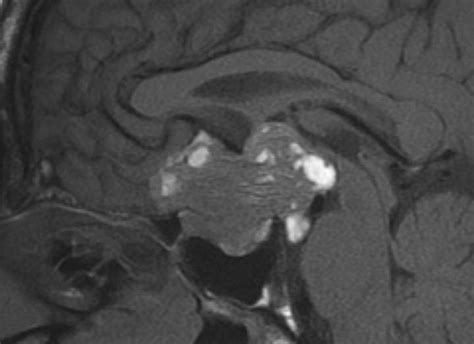 Radiology Of The Pituitary Endotext NCBI Bookshelf