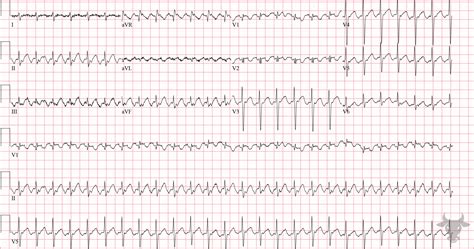Atrial Flutter Ecg Stampede