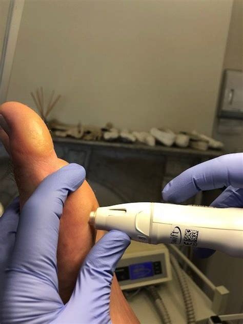 SWIFT Plantar Wart Treatment Clifton Hill