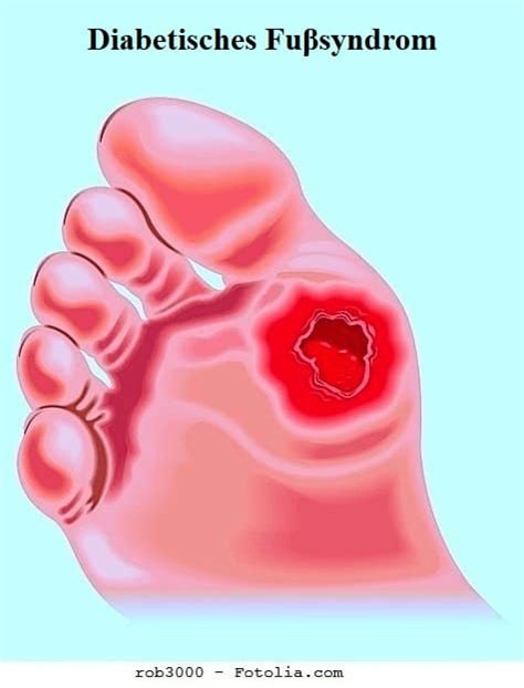 Diabetisches Fußsyndrom Behandlung Naturheilmittel Pflege Amputation