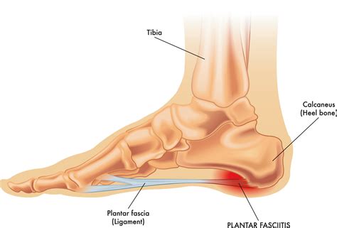 Fascitis Plantar S Ntomas Y Tratamiento Cl Nica Dkf