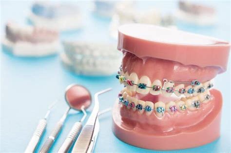 Microtornillos en Ortodoncia qué son y para qué se usan Clínica Pfaff