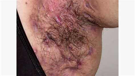 ACD A Z Of Skin Hidradenitis Suppurativa Atelier Yuwa Ciao Jp