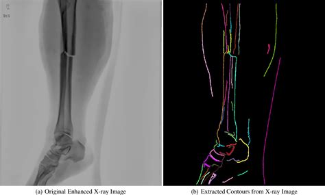 figure 2 from long bone fracture detection using artificial neural networks based on line