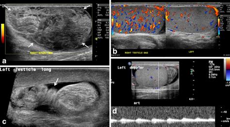 Testicular Torsion With Preserved Flow Key Sonographic Features And
