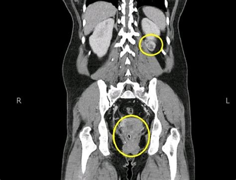 Computed Tomography CT Scan Of The Abdomen And Pelvis Showing A