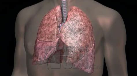 Qué es la fibrosis pulmonar y cuáles son sus principales síntomas