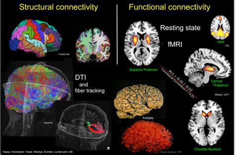 Structural And Functional Connectivity Assessed With Multimodal Mri