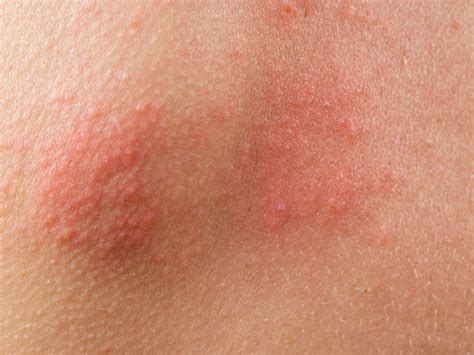 Cause E Sintomi Dellorticaria