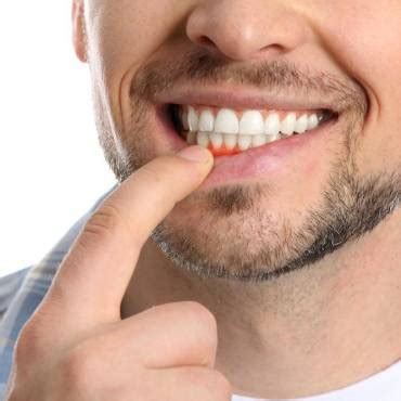 Implant Dentar Pret Clinica Germandent Implant Dentar Bucuresti