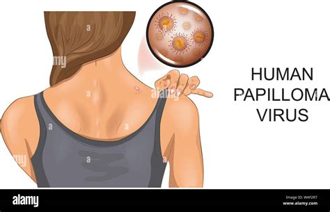 Hpv Virus In Women