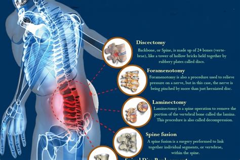 Spine Surgery Types Of Spine Surgery Boston Neurosurgery