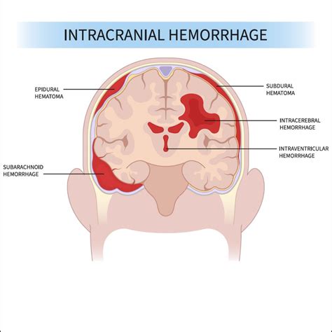 Intracranial Hemorrhage Causes Risk Factors Symptoms Treatment