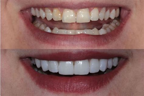 Lente De Contato Dental Sabre Odonto