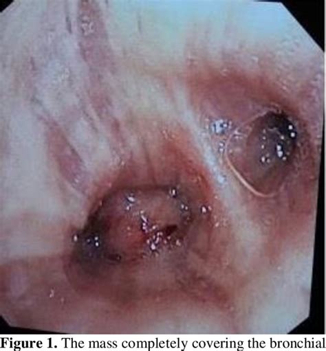 Figure 1 From An Inappropriate ADH Syndrome And Lung Cancer Diagnosis