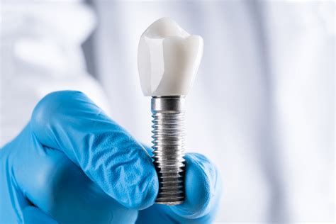 Problemas Con Implantes Dentales Consejos Y Tratamientos Tiiz