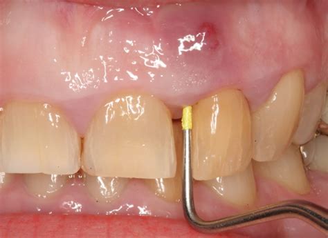Qué es un flemón dental Causas y maneras de evitarlo