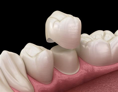 Coronas Dentales De Porcelana Tipos E Indicaciones Estudi Dental