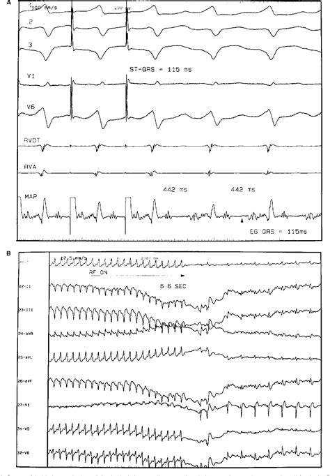 Figure 2 From Entrainment Mapping Criteria For The Prediction Of