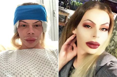 Meghan Markle Wannabe Mum Of 3 Spends 19k On Plastic Surgery To Look
