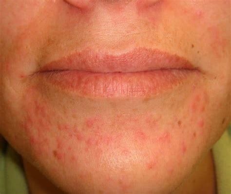 Dermatitis Perioral Qué es Causas Síntomas Tratamiento y más
