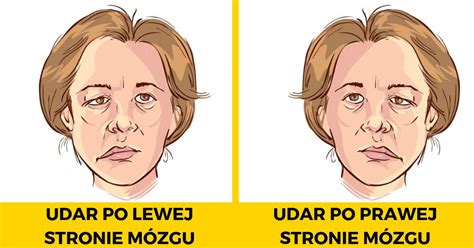 Objawy udaru mózgu bardzo prosty test który może uratować życie