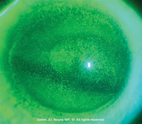 Counteract Corneal Complications