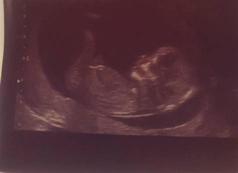 Baby S Gender Skull Nub Theory