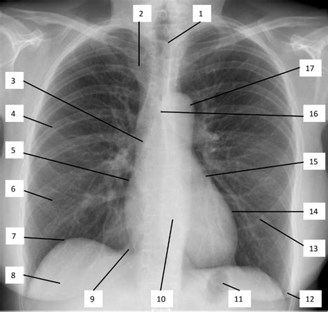 Chest Radiograph Diagram Quizlet