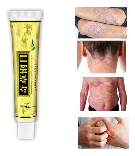 Melhor Pomada Para Dermatite Atopica Psoriase Plurido Parcelamento