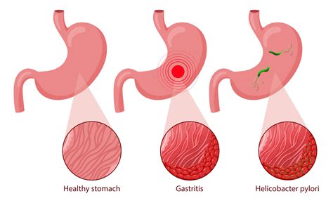 Human Stomach Illustration Healthy With Helicobacter And With