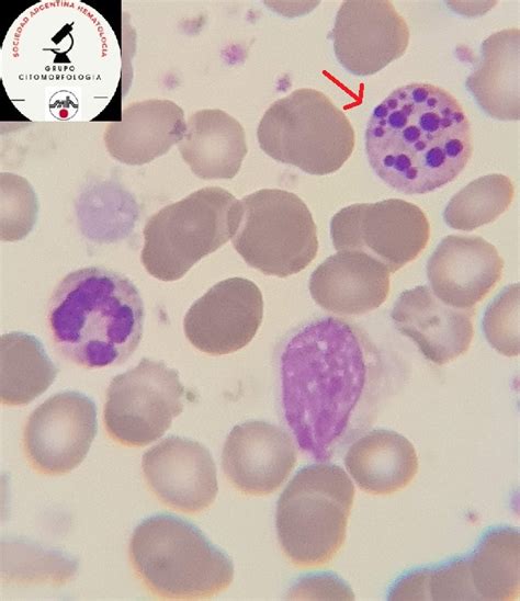 Sociedad Argentina De Hematolog A