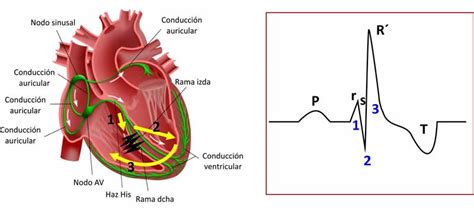 Qué significa en un electrocardiograma bloqueo completo rama derecha