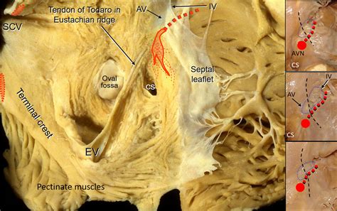 Anatomical Considerations For His Bundle Pacing Circulation