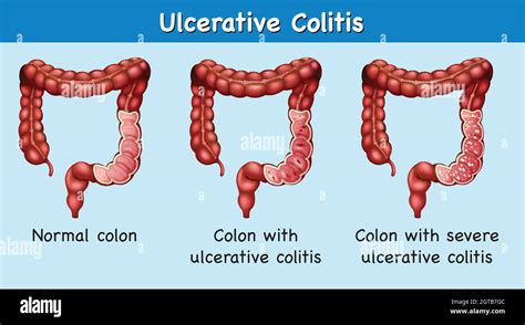 Diagramm Mit Colitis Ulcerosa Stock Vektorgrafik Alamy