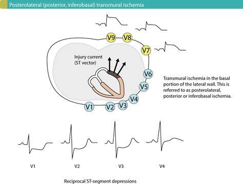 St Elevation Myocardial Infarction Stemi Without St Elevations On