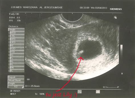 z życia Lily pierwsze USG 8 tydzień moje ciałko ma 1 6 mm dł