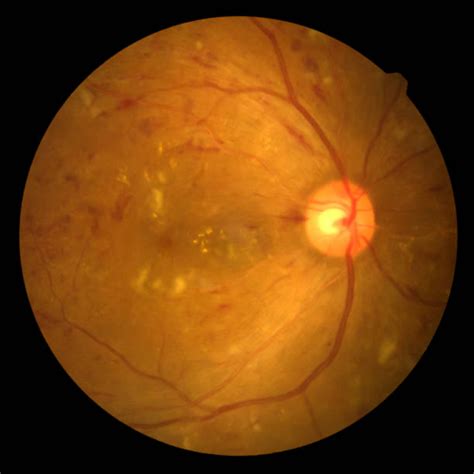 Tratamento de Retinopatia Diabética Avançada Luz Retinopatia