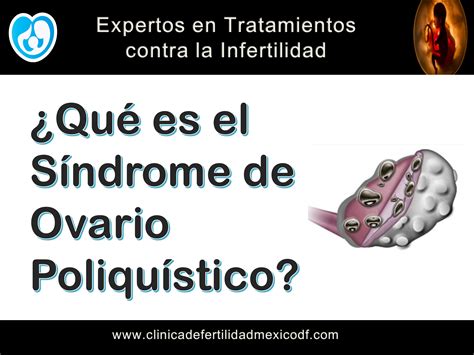 Qu Es El S Ndrome De Ovario Poliqu Stico Powerpoint Presentation Ppt