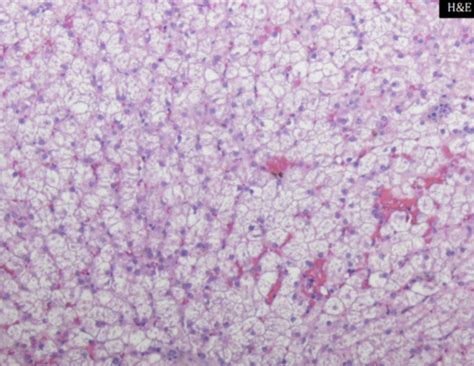 Pathology Exam Labs Flashcards Quizlet