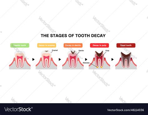 Stages Of Tooth Decay Flat Royalty Free Vector Image