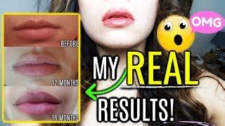 How Do I Make My Lips Bigger Without Makeup Permanently Lipstutorial Org
