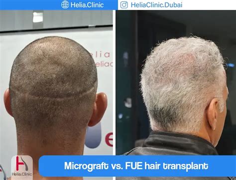Micrografting Hair Transplant Before And After Photos Helia Clinic