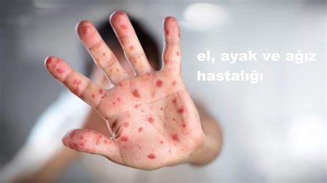el ayak ve ağız hastalığı BilginCin