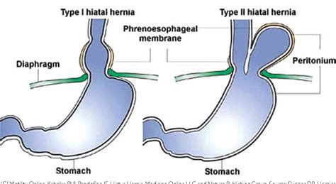 Figure 1 From Laparoscopic Surgical Treatment Of Paraesophageal Hiatus
