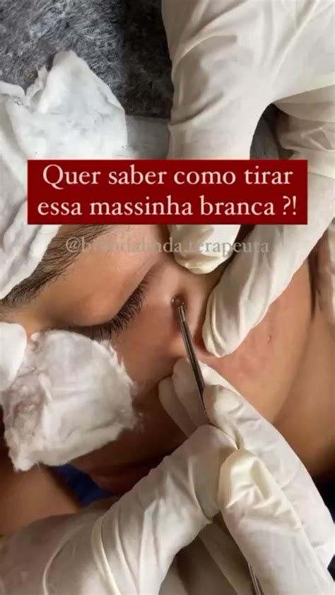 Para evitar esses grãos brancos no rosto chamados de grão de milium
