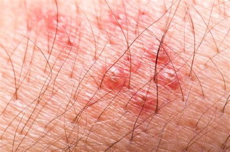 Top 19 tipos de alergia na pele que coça 2022