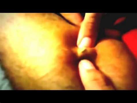 Sebaceous Cyst Popping Youtube