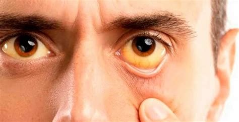 Olhos Amarelados Principais Causas Sintomas E O Que Fazer Lenscope