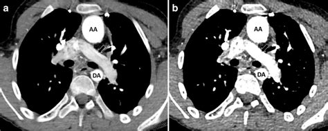 Optimization Of Contrast Opacification Of Computed Tomography Pulmonary